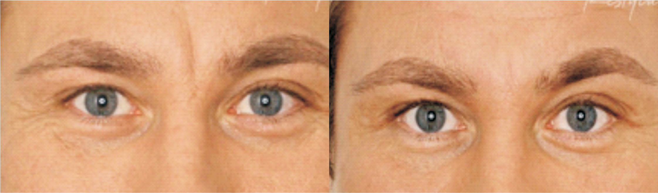 Dermal Filler & Skin Filler in Mumbai | Skin And Physio Clinic